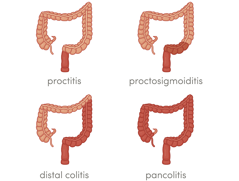 Simptome, diagnostic si tratament ale RCUH – grija pentru viata