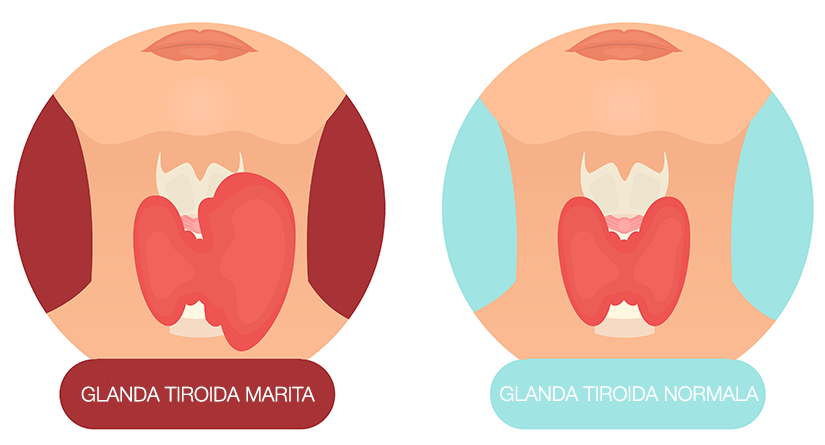 Hipertiroidism: semne si simptome generale | Reginamaria.ro