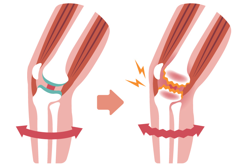 Totul despre gonartroza-cauze, stadii, tipuri, diagnostic si tratament ...