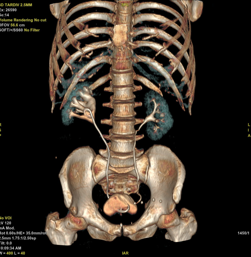 Calcul renal coraliform indepartat complet prin ureteroscopie cu ...