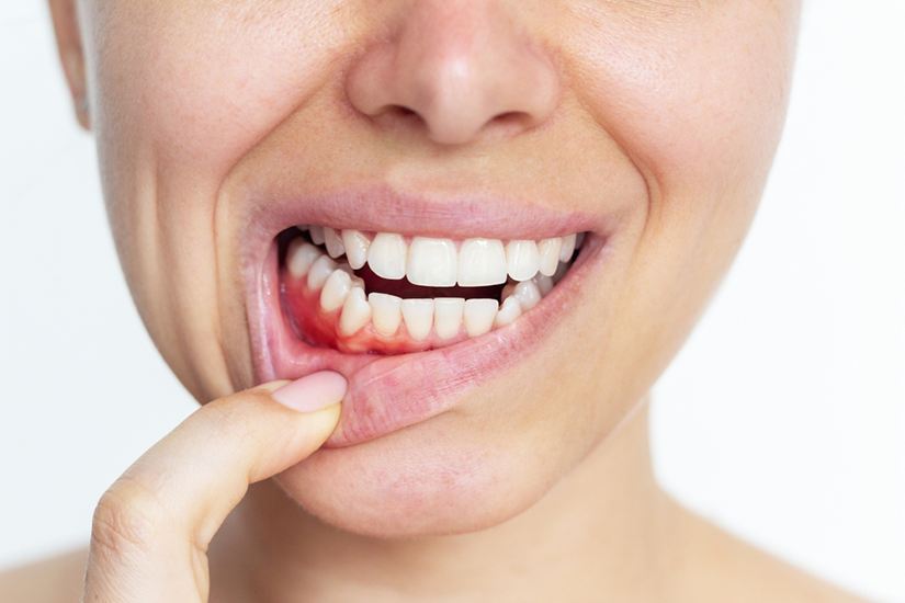 Ce este sangerarea gingivala: Simptome, tratament | Reginamaria.ro