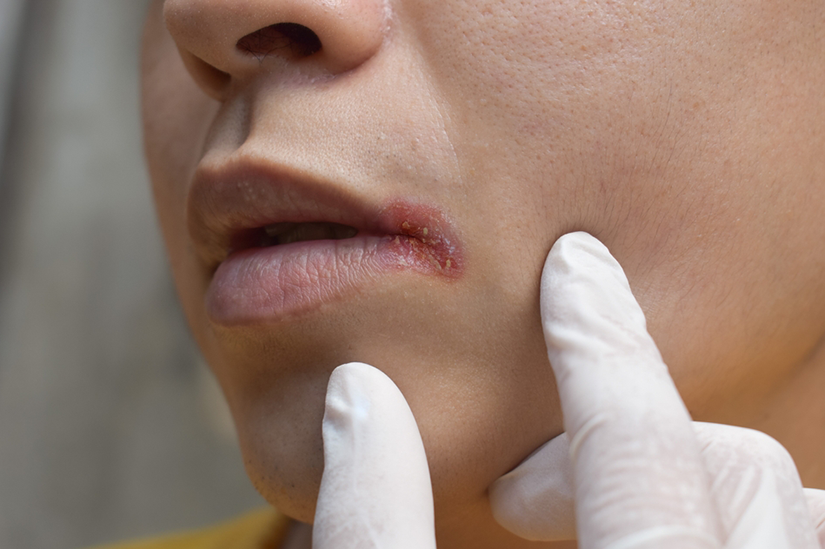 Cheilita angulara: cum o recunosti | Reginamaria.ro