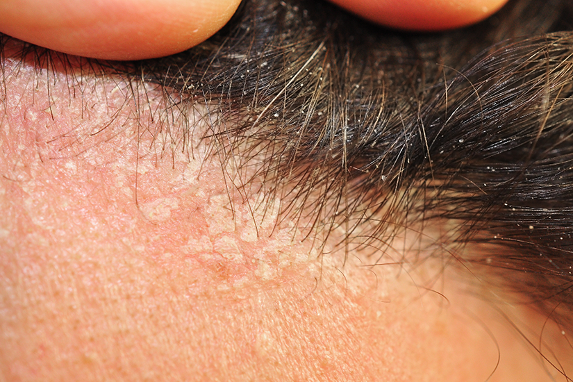 Dermatita seboreica a scalpului: cauze, simptome, tratament ...