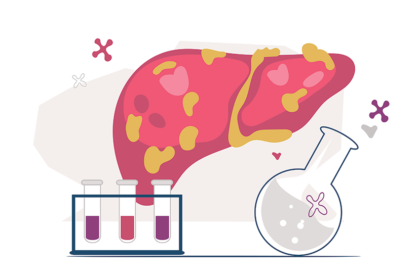 Ficat gras (steatoza hepatica): Cauze si regim | Reginamaria.ro